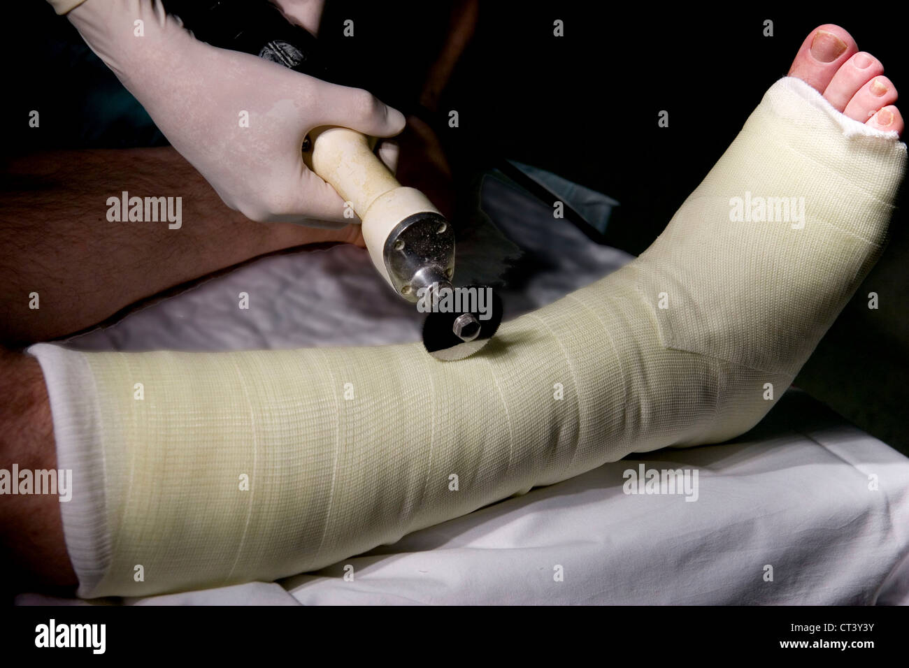 Plaster Leg Cast Legs Stock Photos & Plaster Leg Cast Legs Stock Images ...