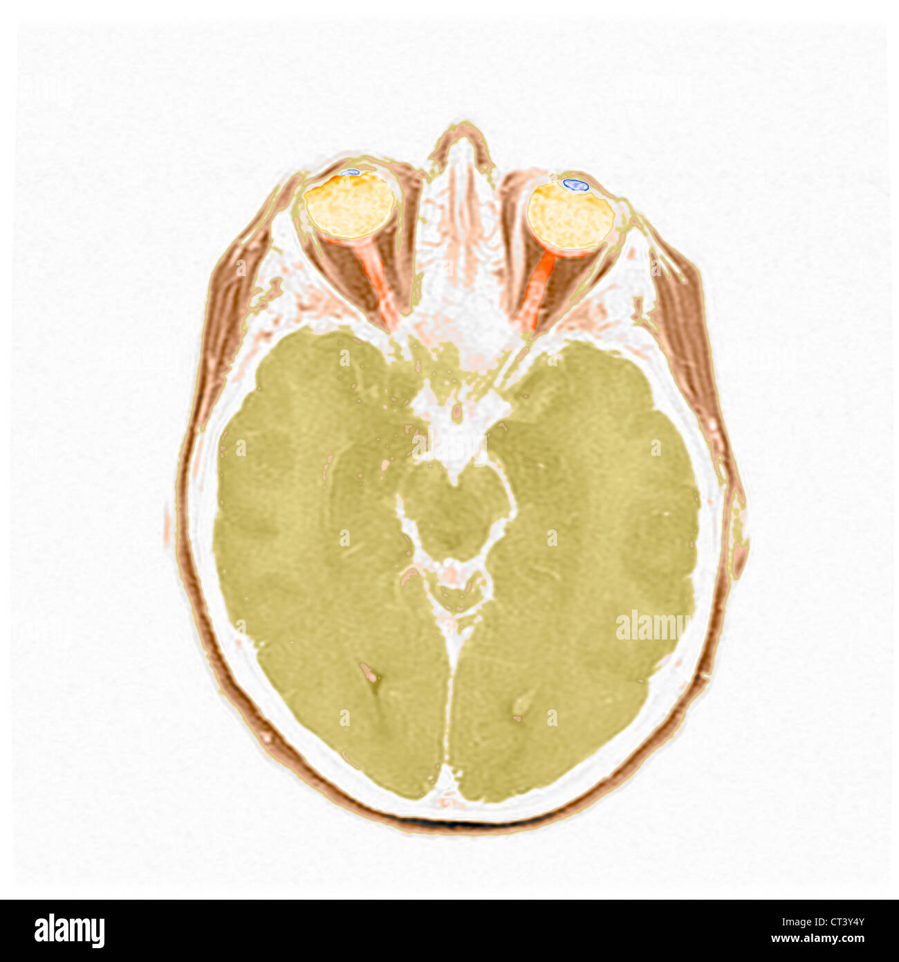 Normal brain scan hi-res stock photography and images - Alamy