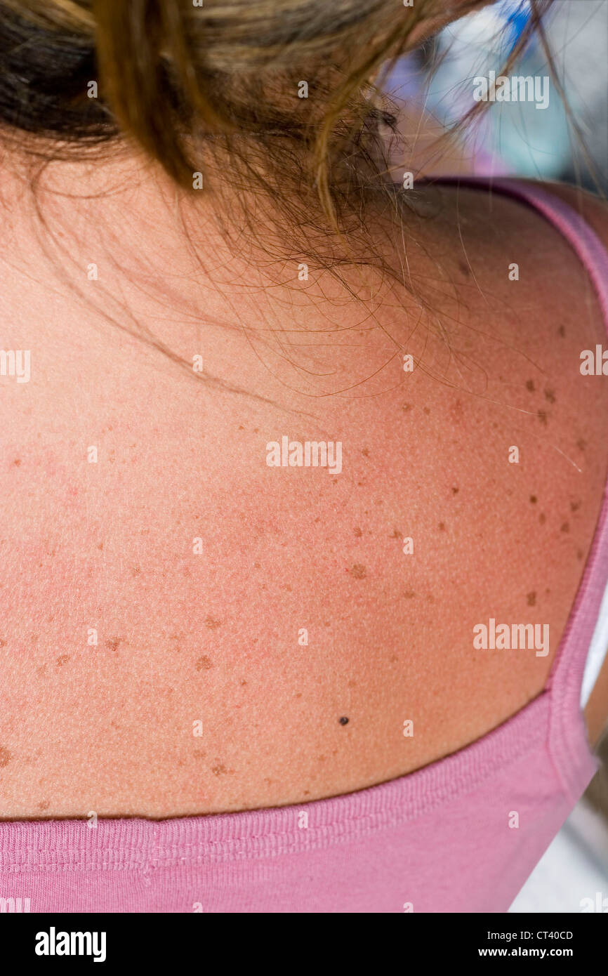Erythema solar hi-res stock photography and images - Alamy