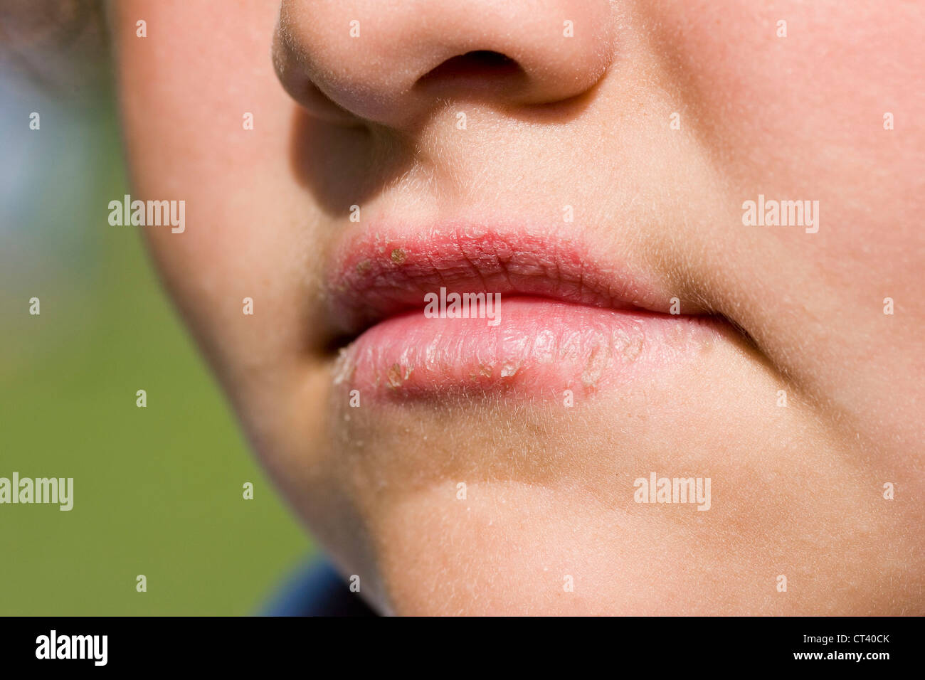 Lip chapping hi-res stock photography and images - Alamy