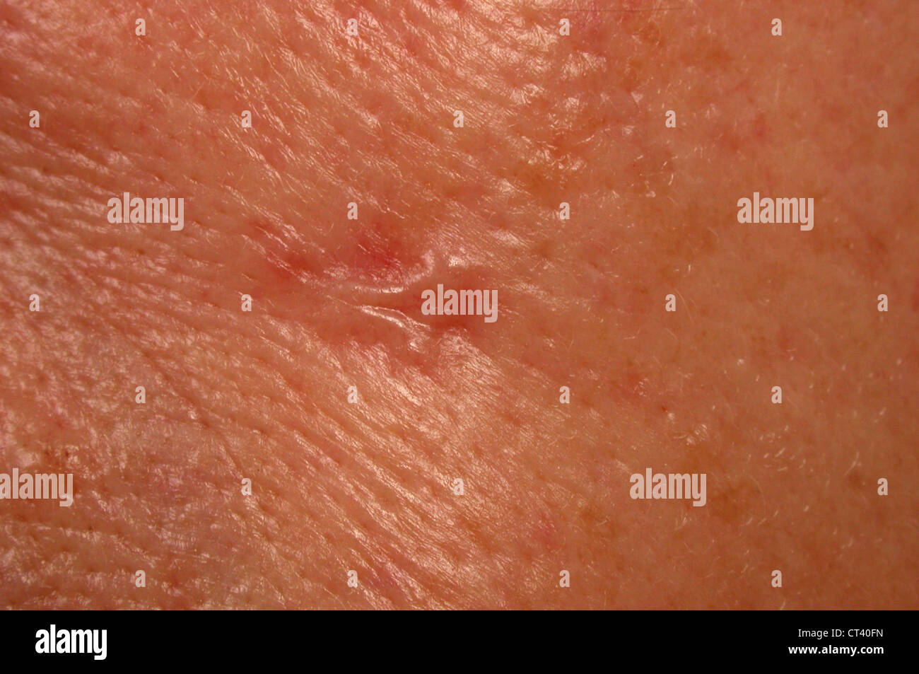 BASAL CELL CARCINOMA Stock Photo - Alamy