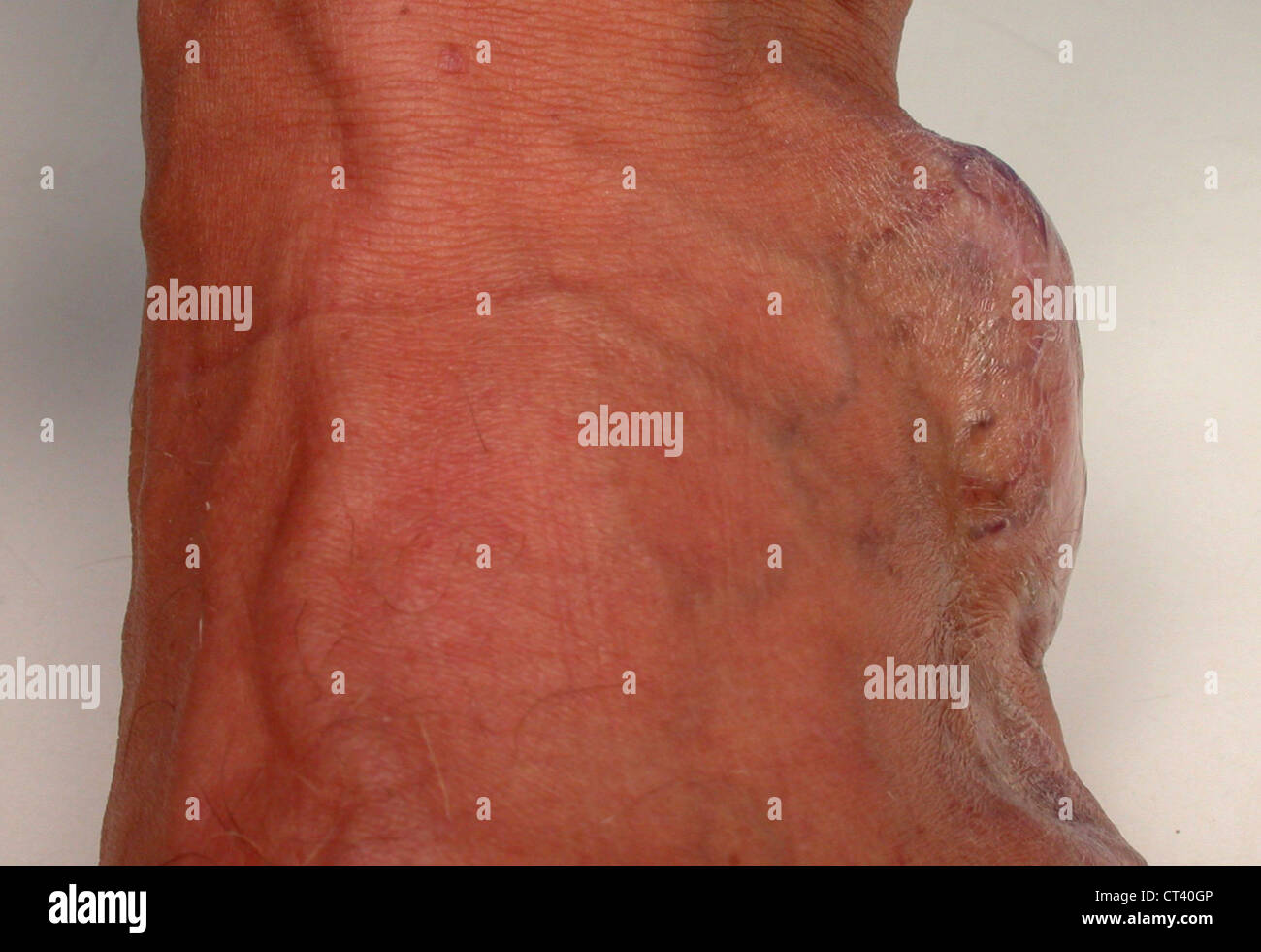 Dermatofibrosarcoma protuberans hi-res stock photography and images - Alamy