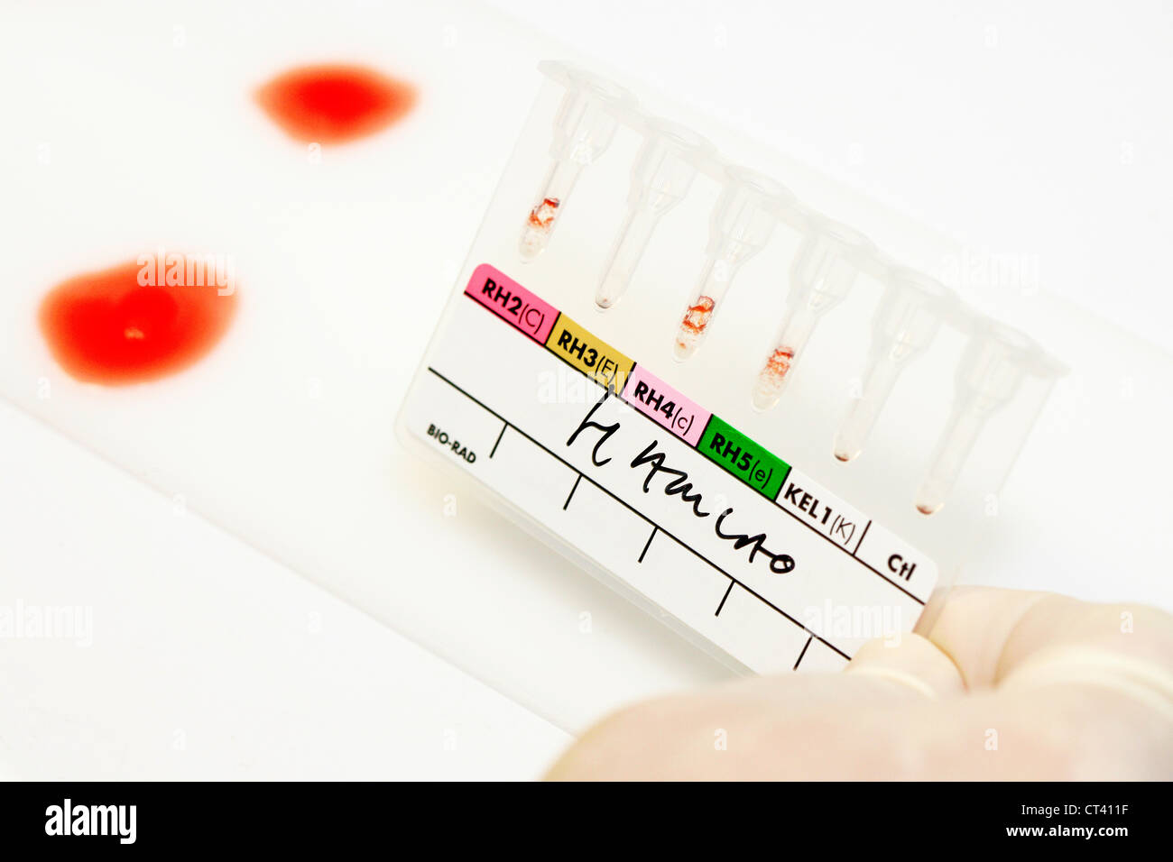 Abo blood type testing hi-res stock photography and images - Alamy