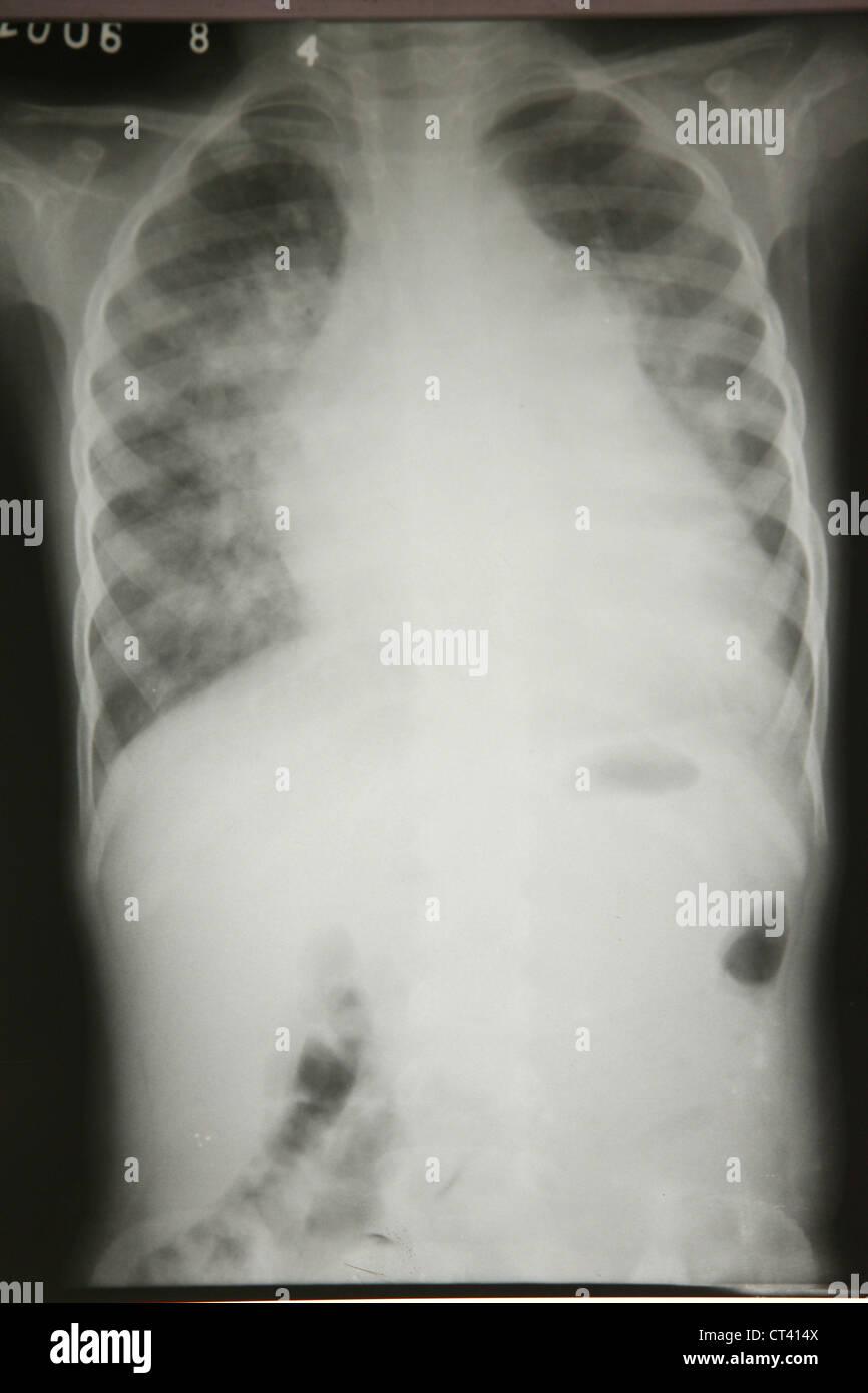 CONGENITAL HEART MALFORMATION Stock Photo - Alamy