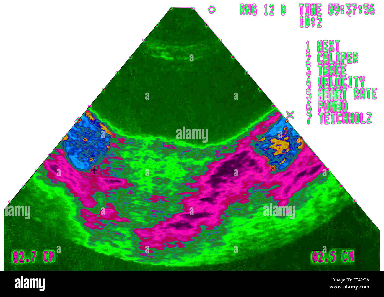 Polycystic ovary syndrome hi-res stock photography and images - Alamy