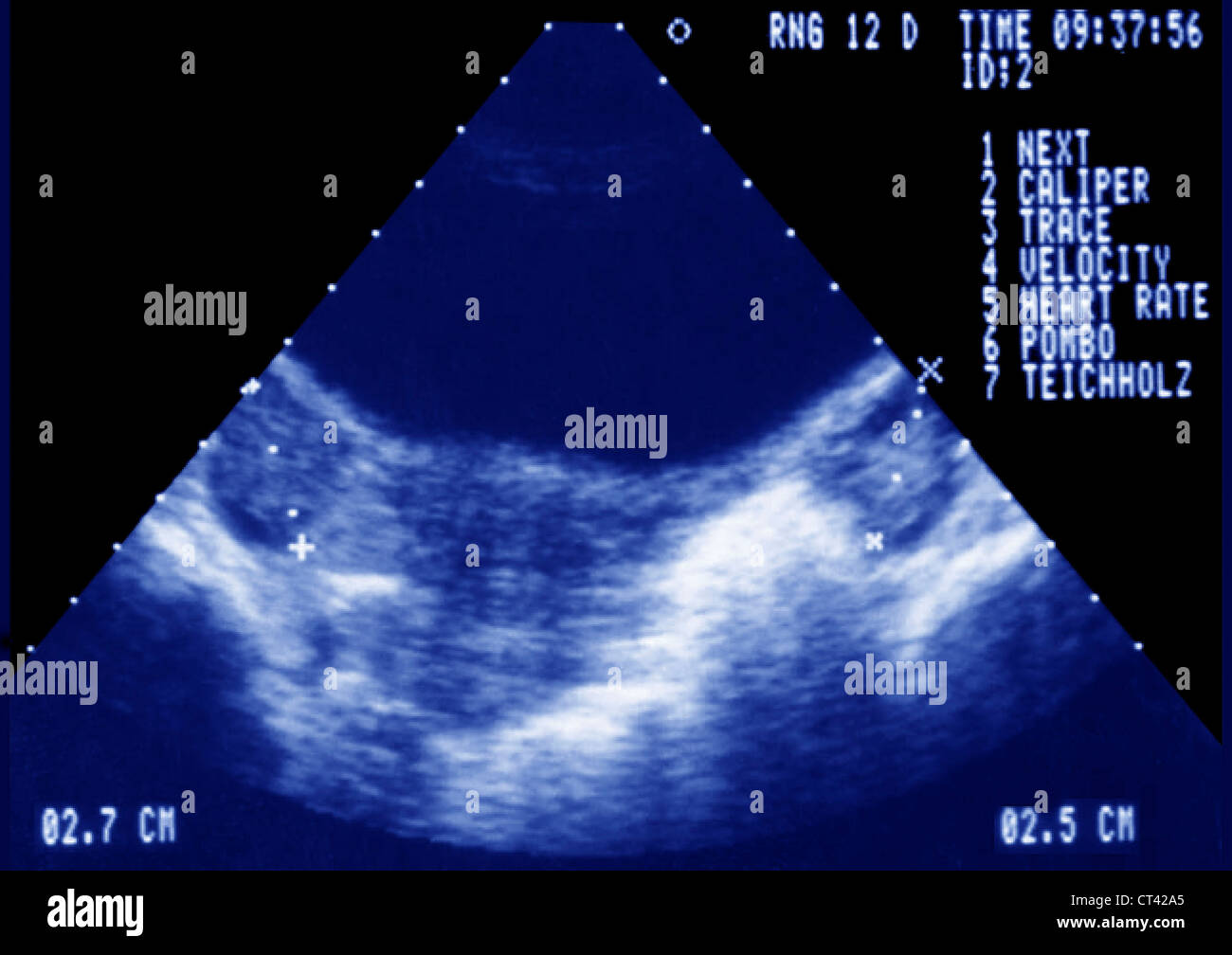 Polycystic ovary ultrasound hi-res stock photography and images - Alamy