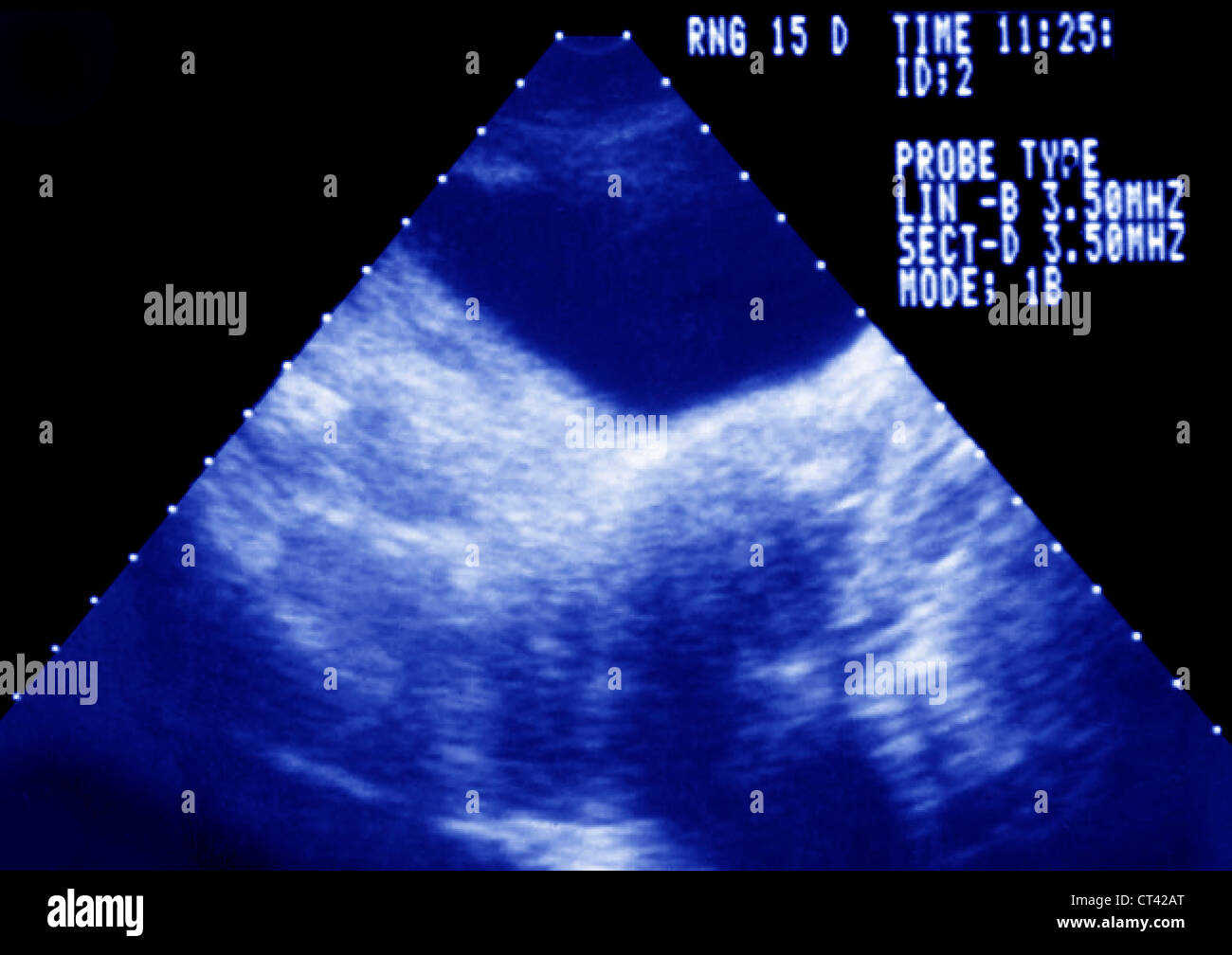 Retroverted uterus hi-res stock photography and images - Alamy