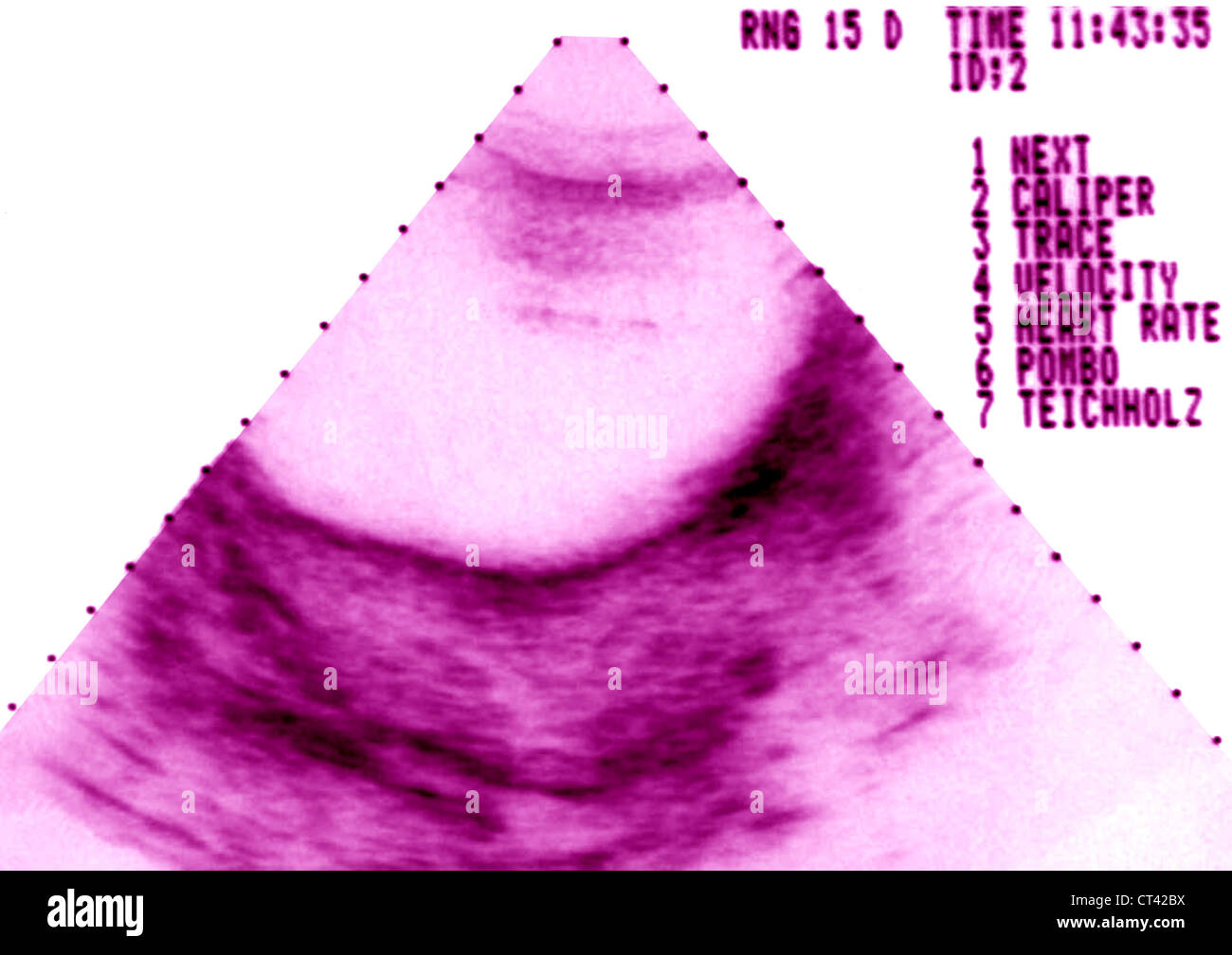 Retroverted uterus hi-res stock photography and images - Alamy