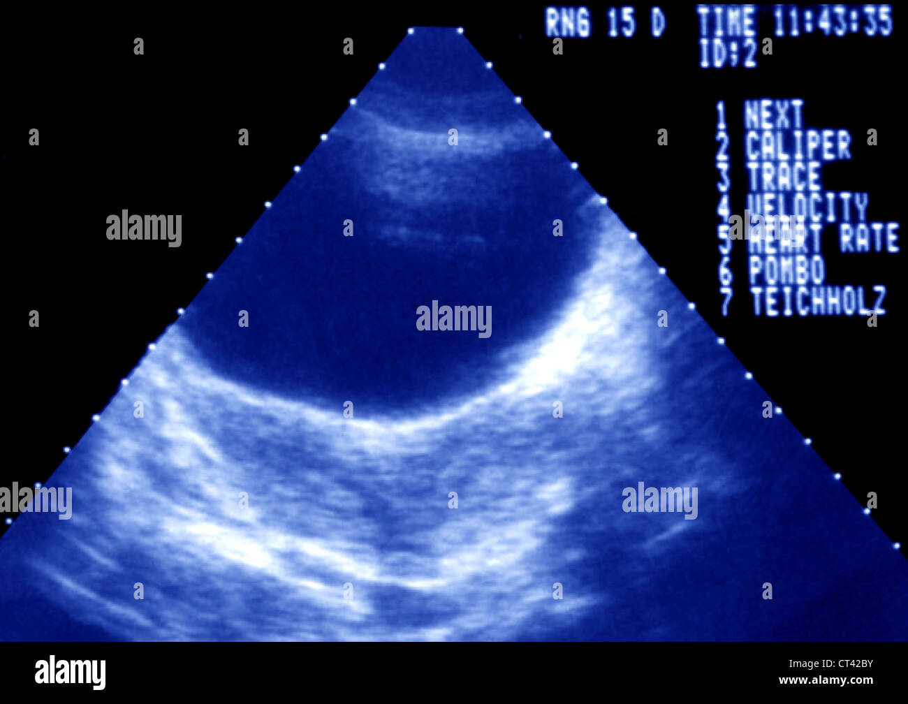 Retroverted uterus hi-res stock photography and images - Alamy