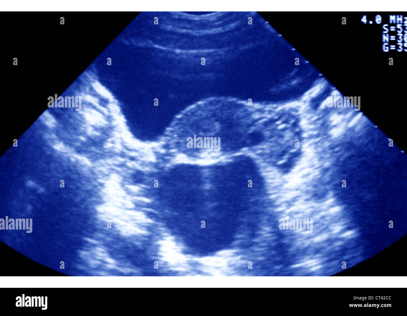 Hydrosalpinx hi-res stock photography and images - Alamy