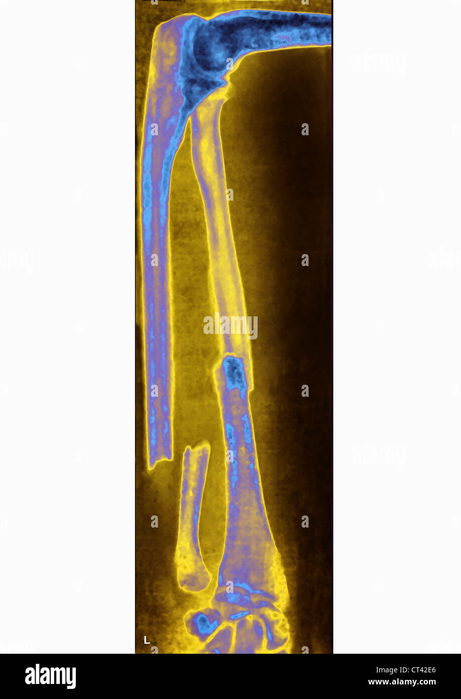 Fractured ulna hi-res stock photography and images - Alamy