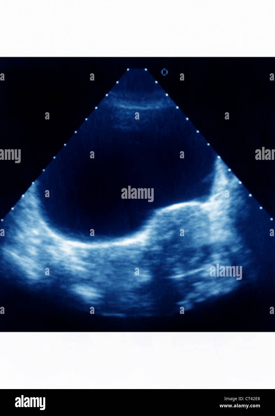 Uterine fibroma ultrasound hi-res stock photography and images - Alamy