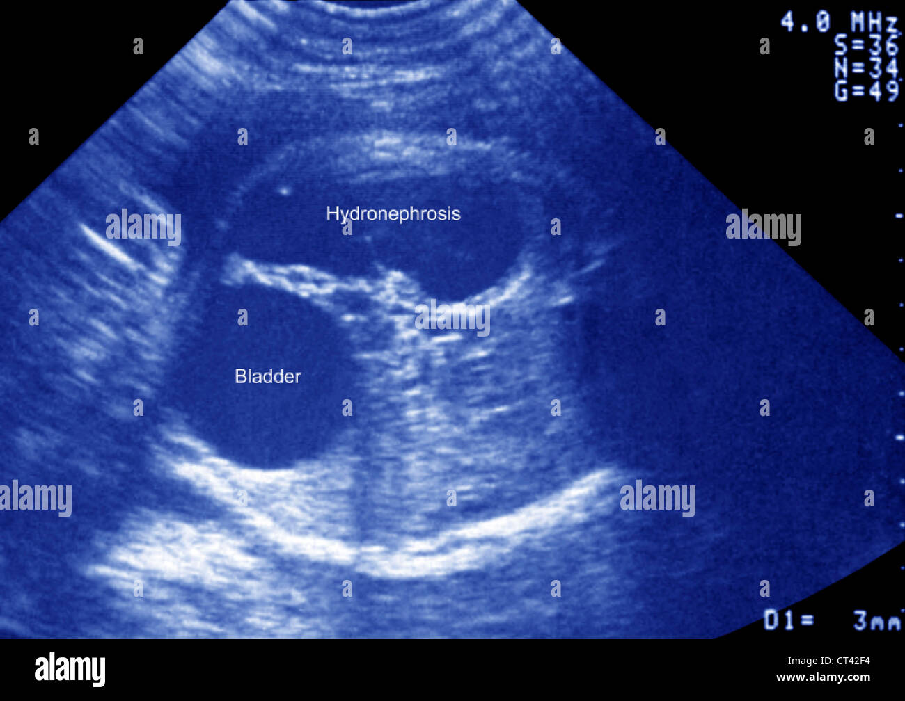 Hydronephrosis hi-res stock photography and images - Alamy