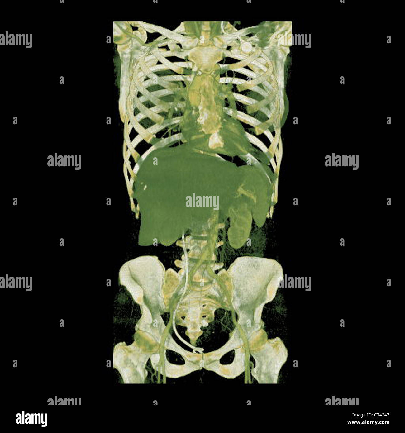 Common iliac artery hi-res stock photography and images - Alamy