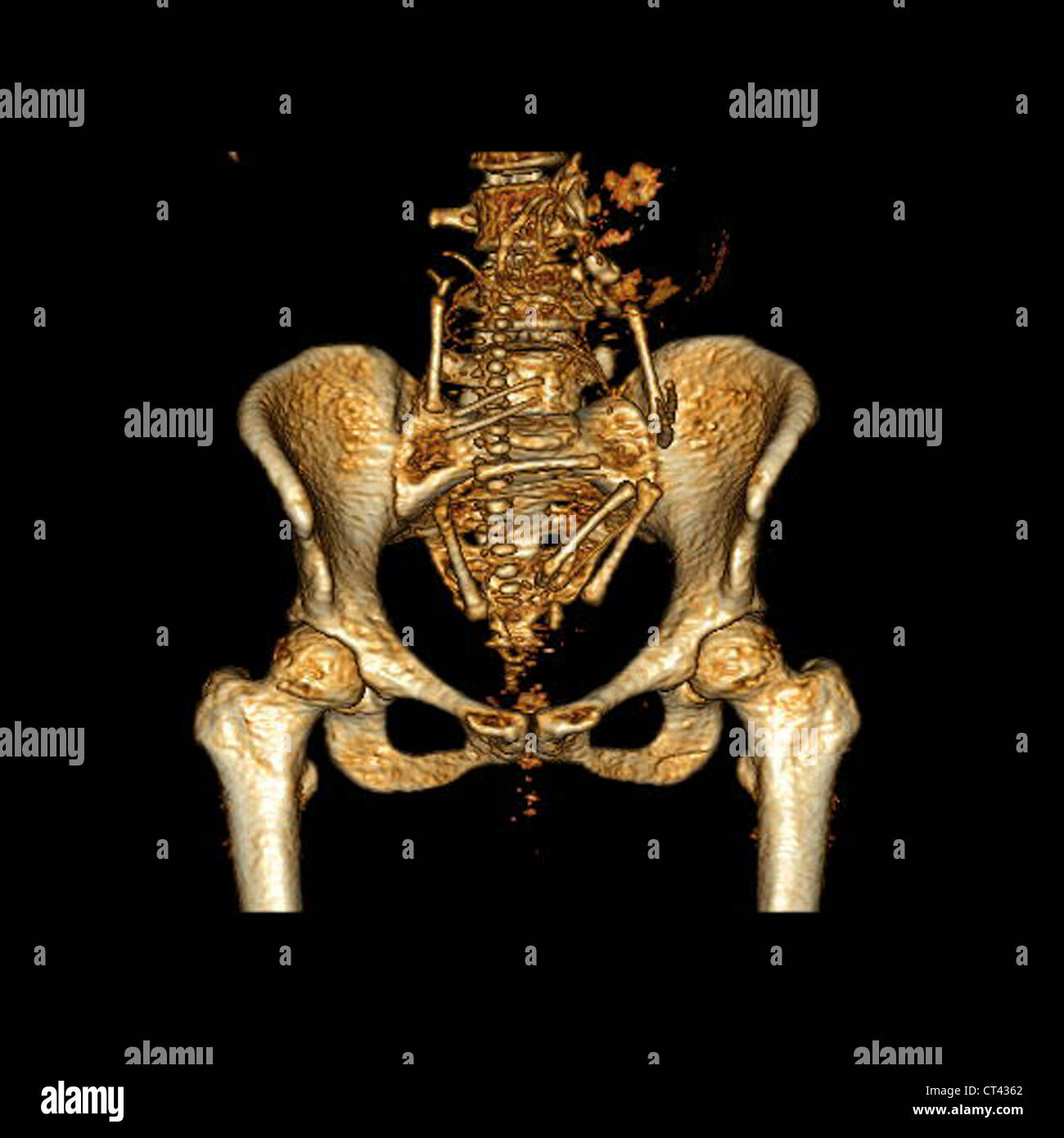 Pelvimetry High Resolution Stock Photography and Images - Alamy