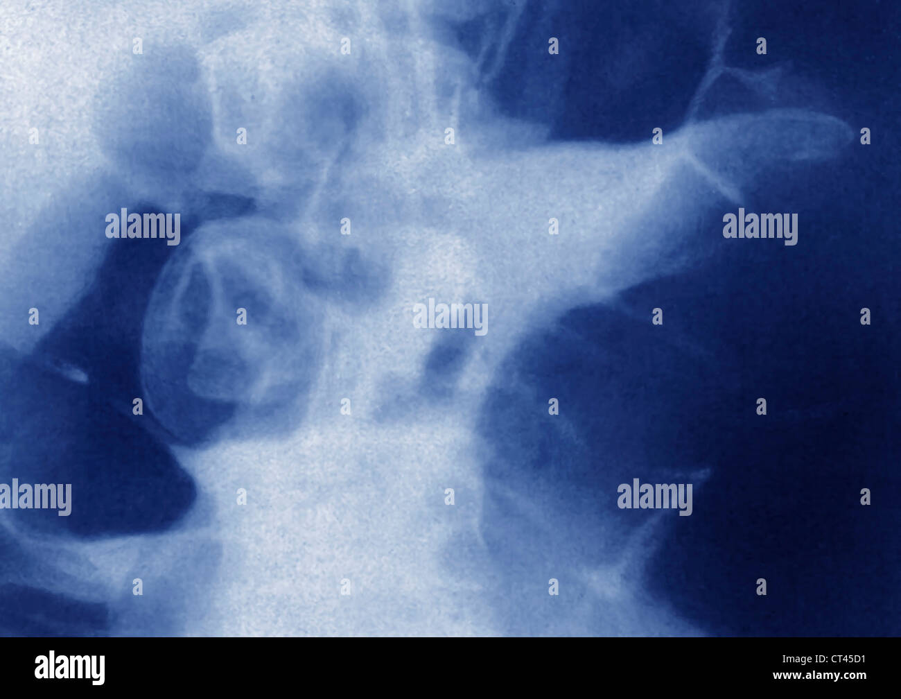 ACUTE PANCREATITIS, X-RAY Stock Photo - Alamy