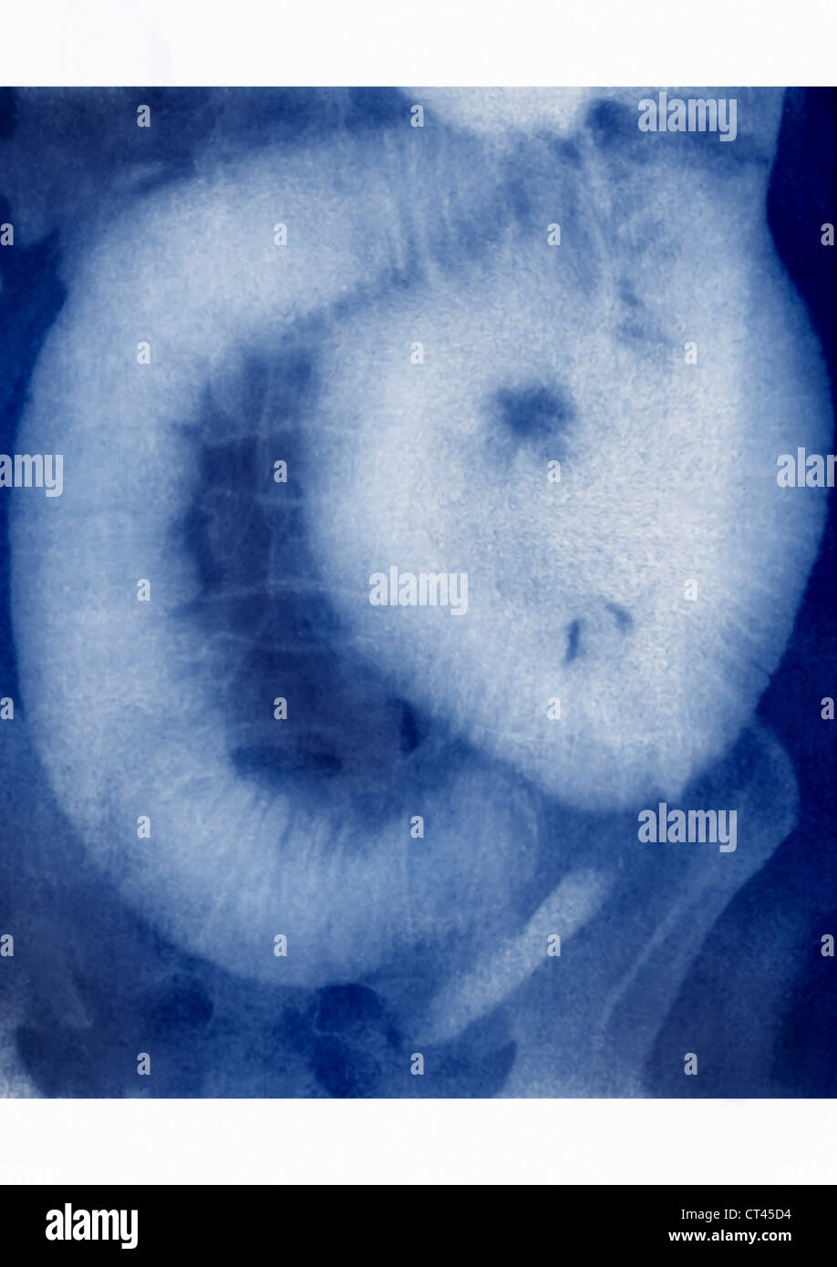 Human small intestine hi-res stock photography and images - Alamy