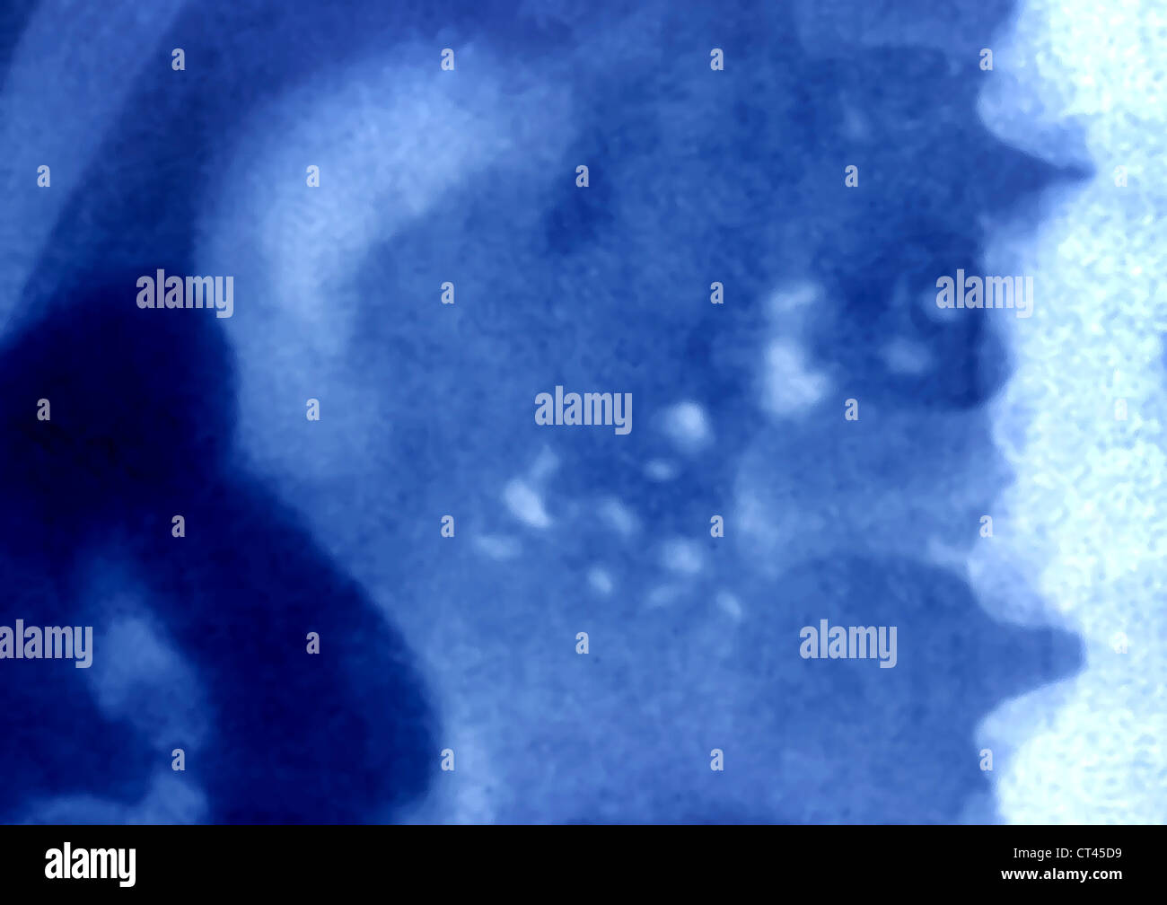 Pancreatic calculus hi-res stock photography and images - Alamy