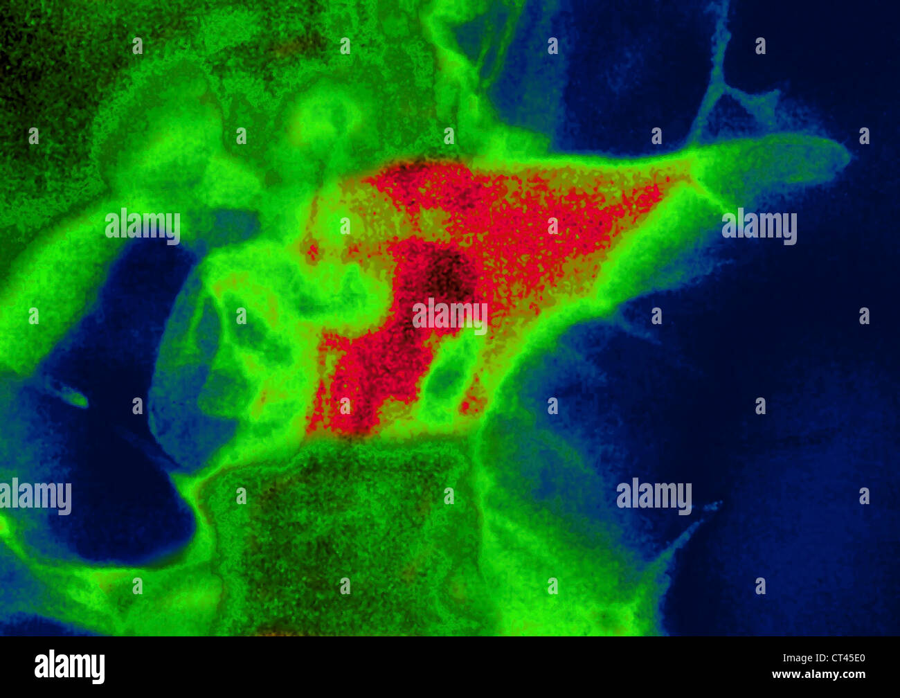 ACUTE PANCREATITIS, X-RAY Stock Photo - Alamy