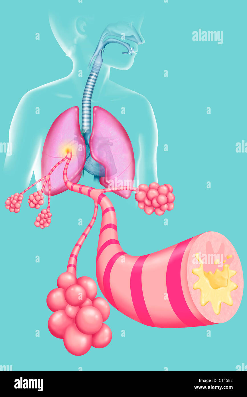 Bronchial Tubes Bronchitis High Resolution Stock Photography and Images ...