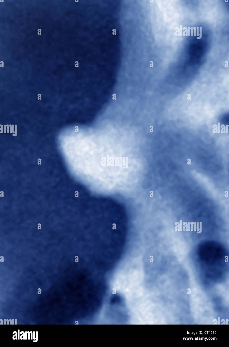 GASTRIC ULCER, X-RAY Stock Photo - Alamy