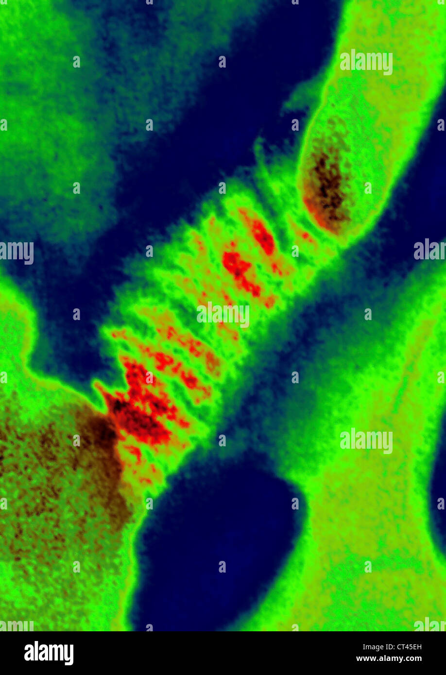 Sigmoiditis hi-res stock photography and images - Alamy