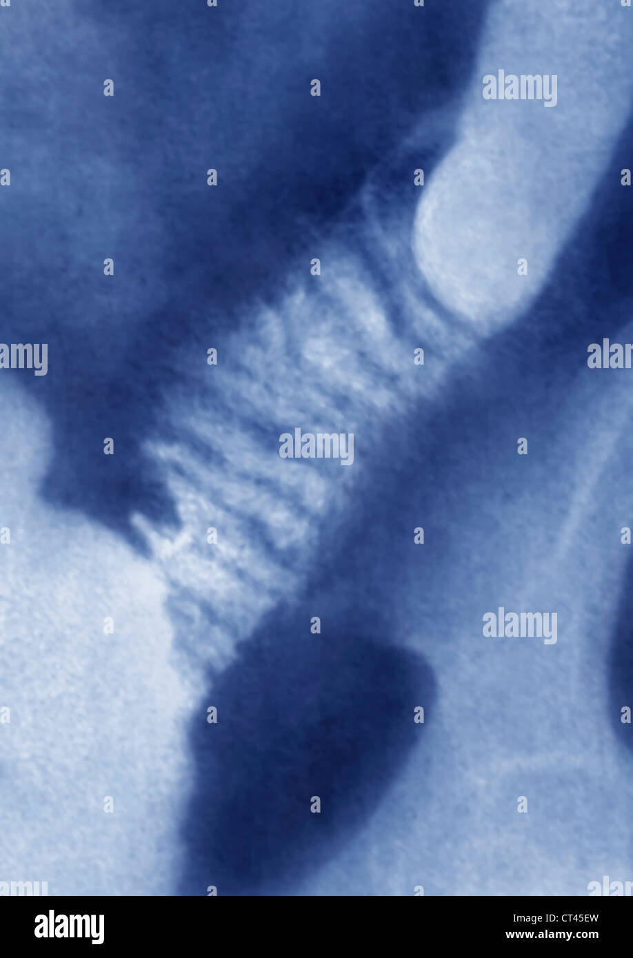 Sigmoid Flexure High Resolution Stock Photography and Images - Alamy