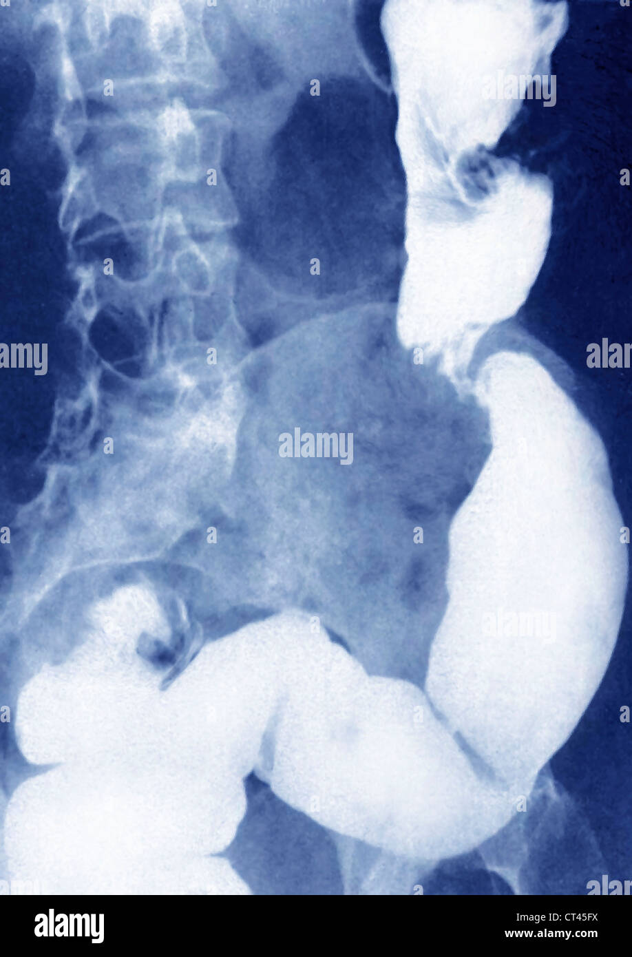 Descending Colon High Resolution Stock Photography and Images - Alamy