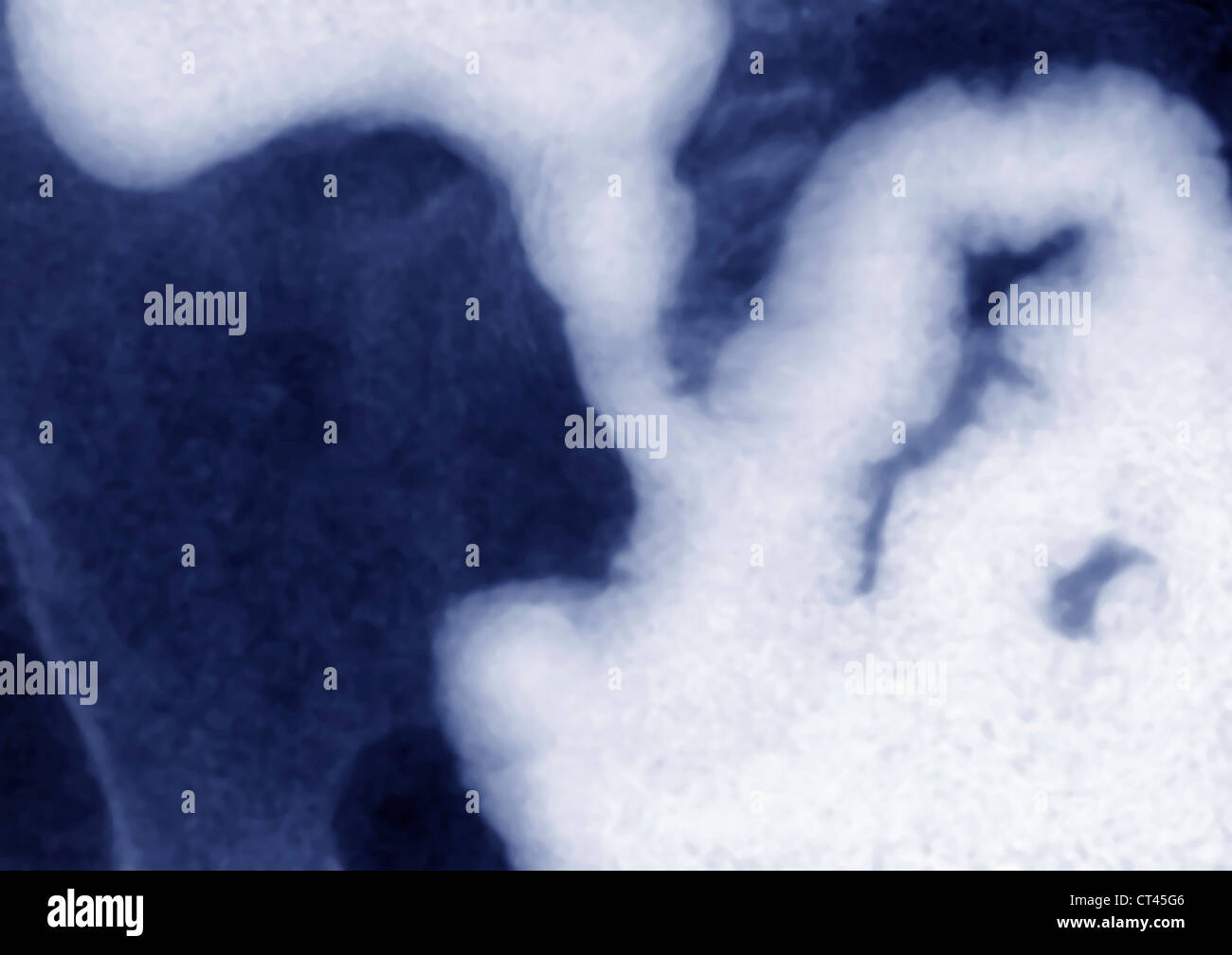 Appendicitis x ray hi-res stock photography and images - Alamy