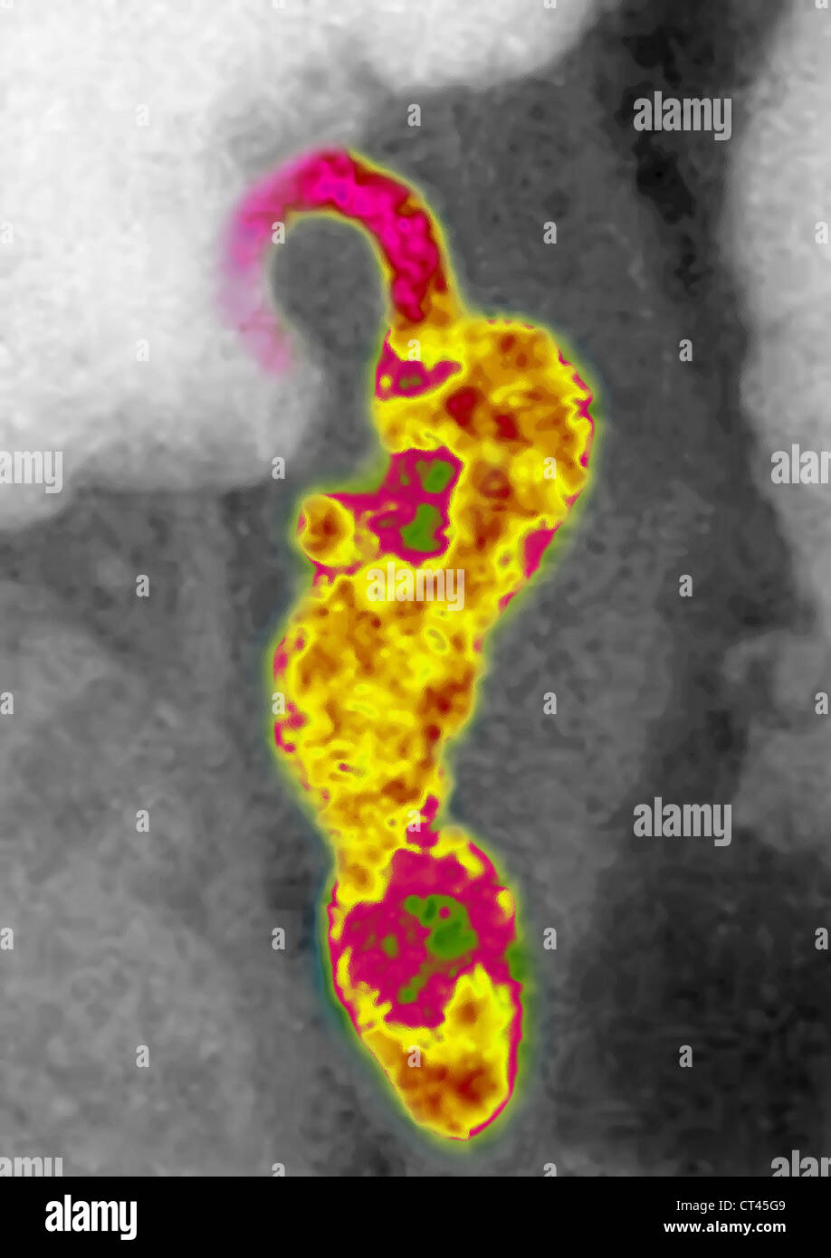 Appendicitis x ray hi-res stock photography and images - Alamy