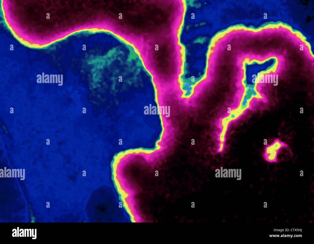 Appendicitis x ray hi-res stock photography and images - Alamy