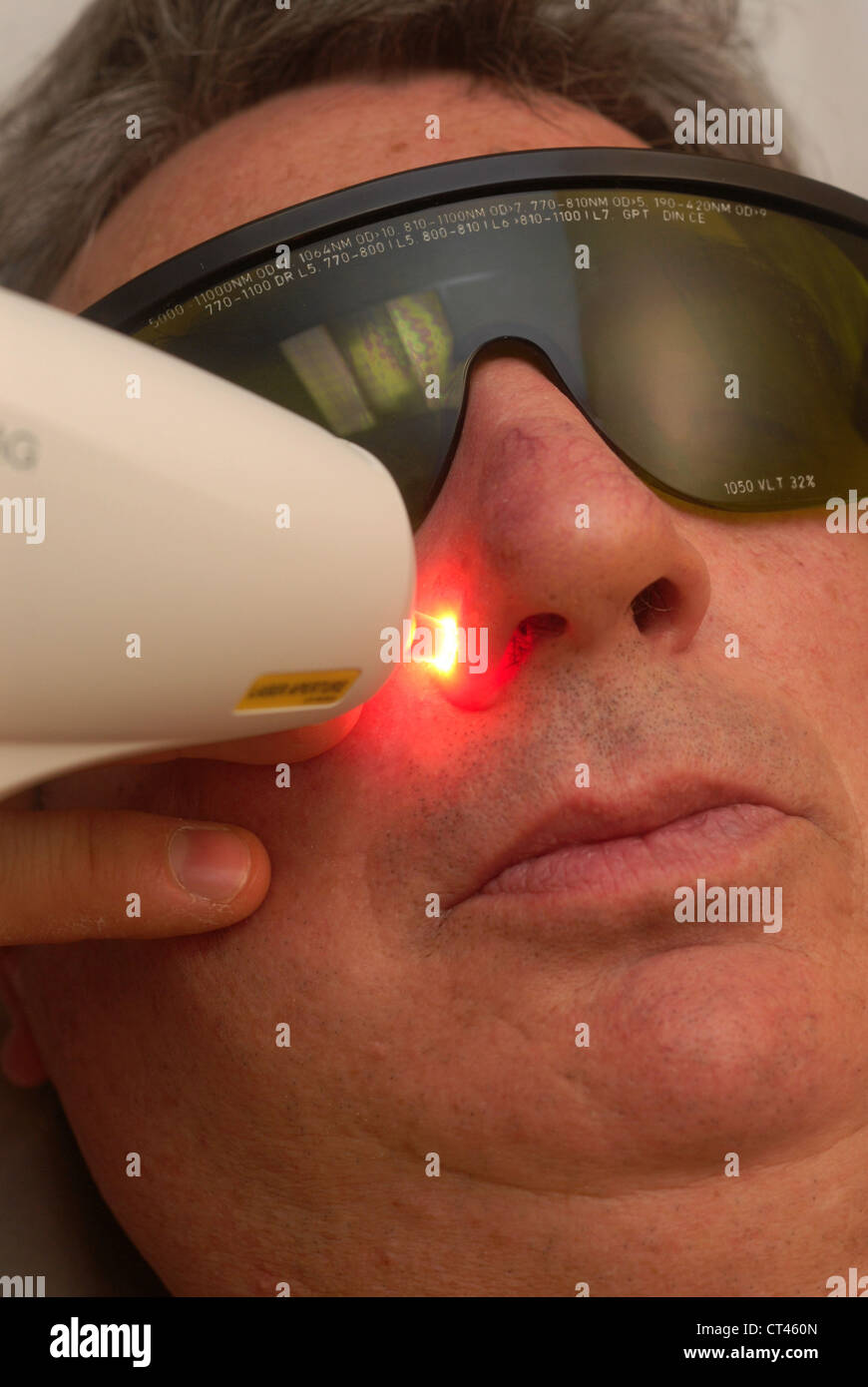 DERMATOLOGY TREATMENT, MAN Stock Photo - Alamy