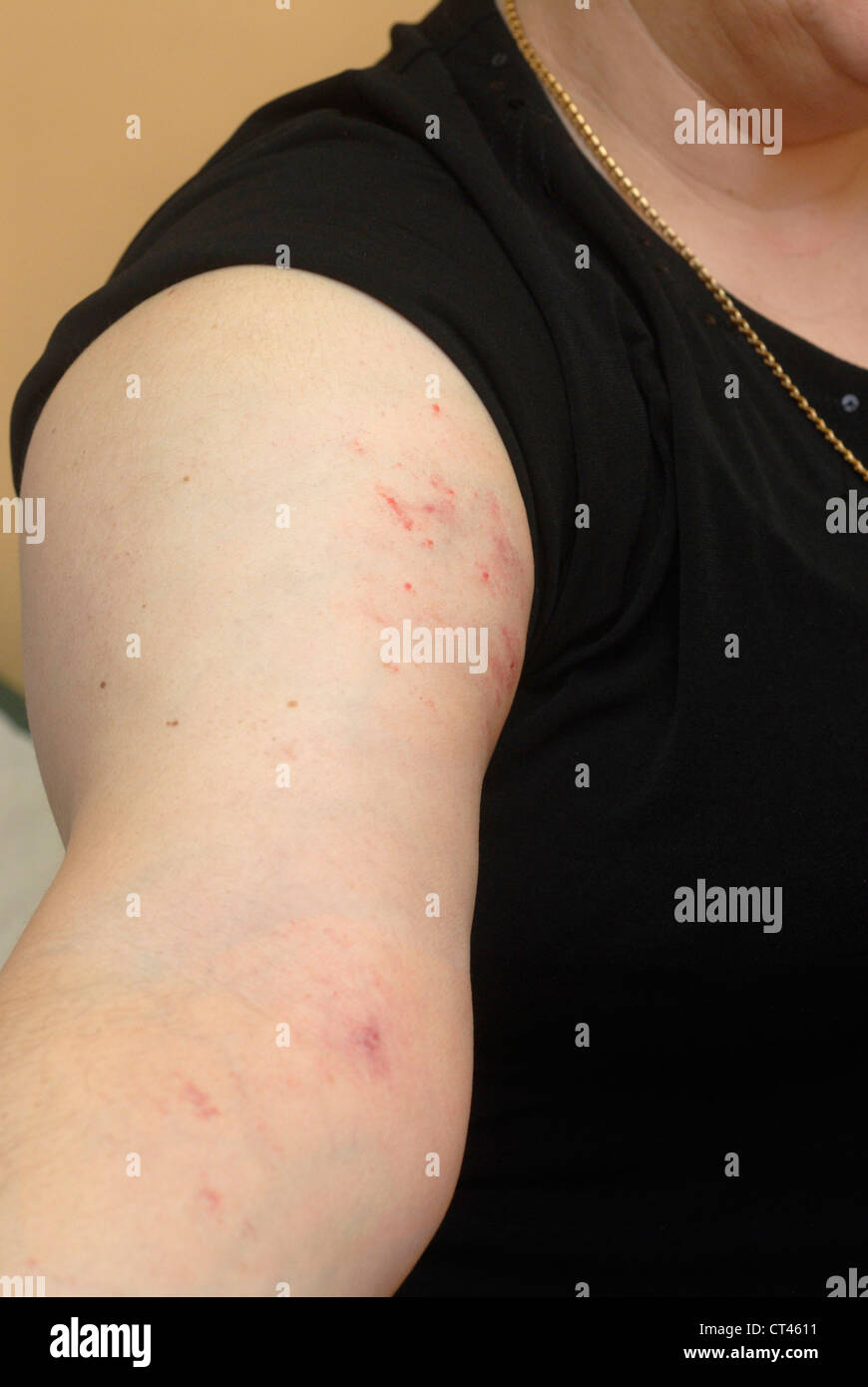 Cutaneous angioma hi-res stock photography and images - Alamy