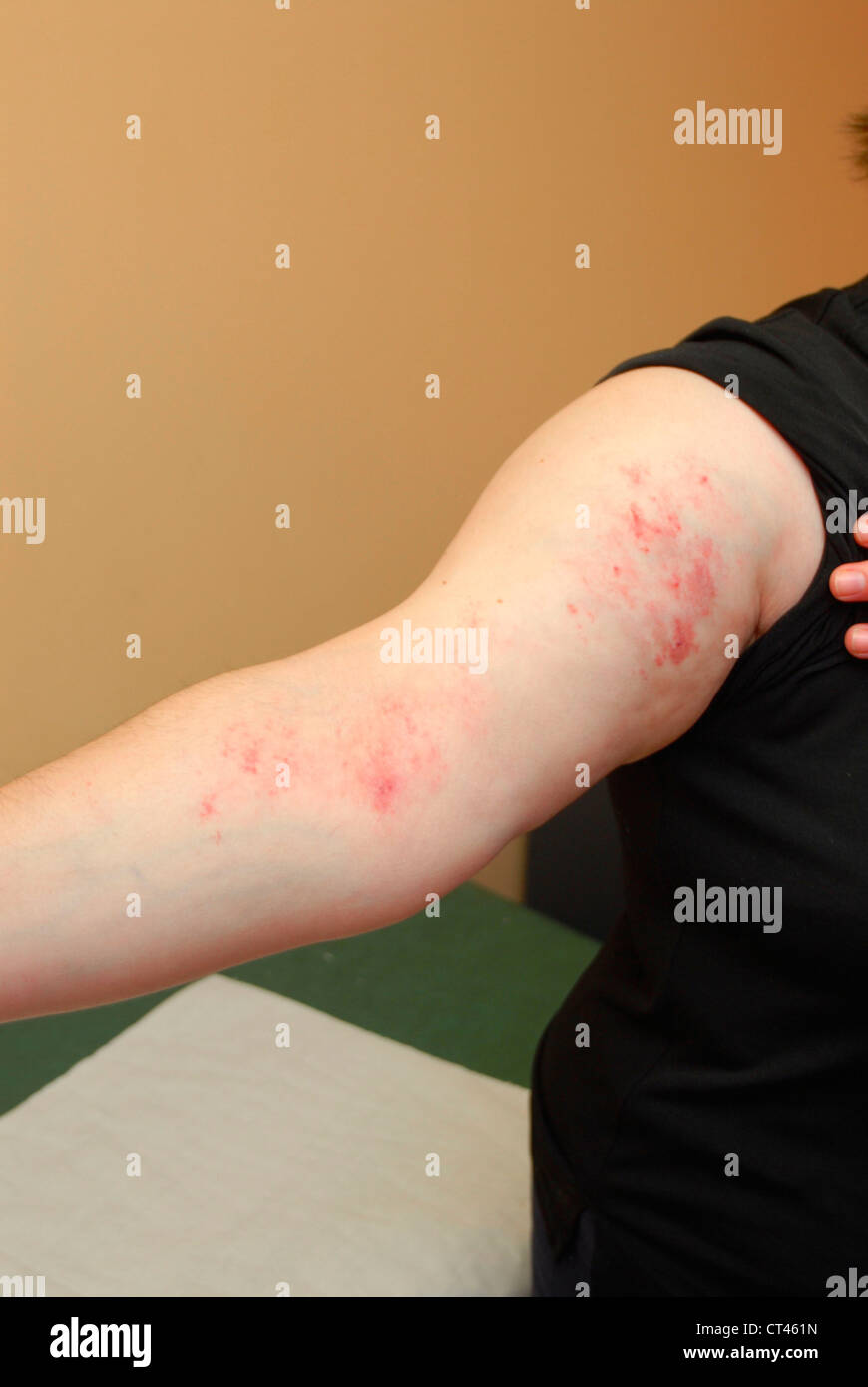 Cutaneous angioma hi-res stock photography and images - Alamy