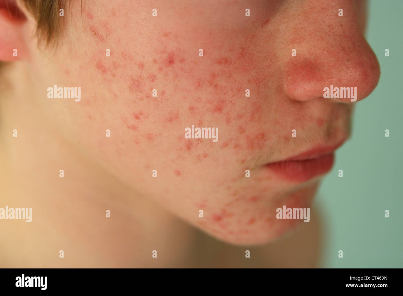 Acne year hi-res stock photography and images - Alamy