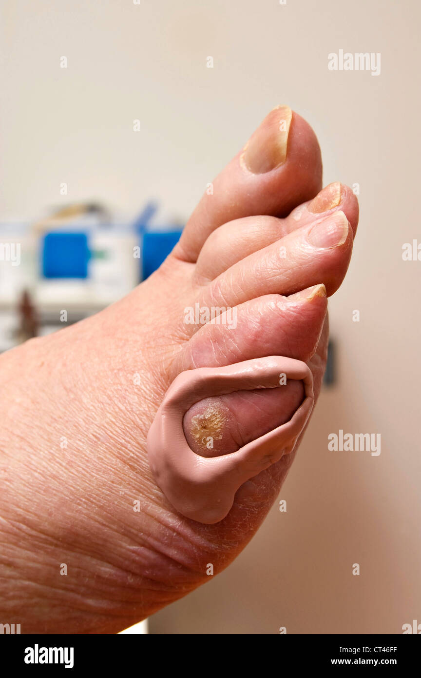 Orthotics foot hi-res stock photography and images - Alamy