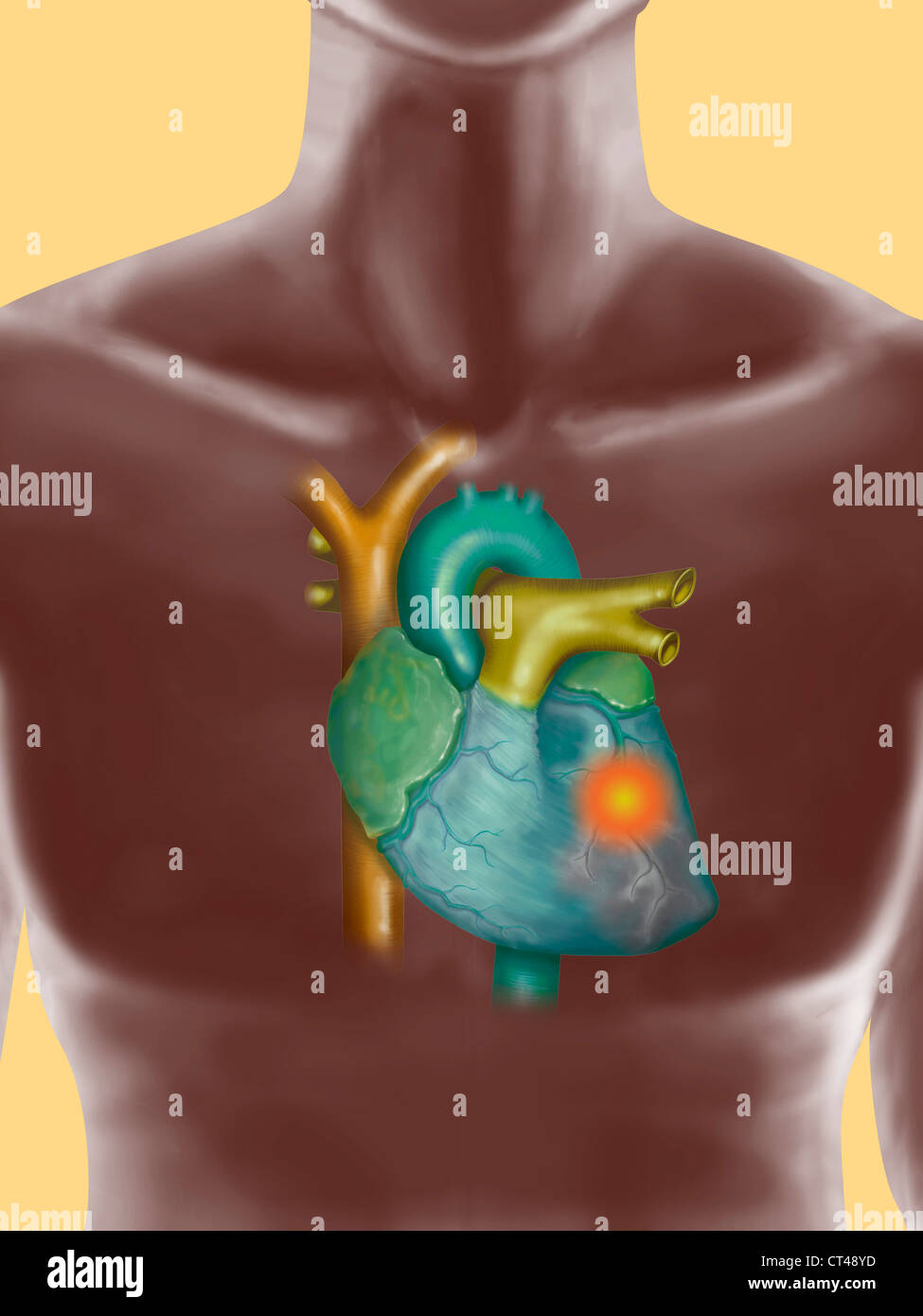 HEART ATTACK, DRAWING Stock Photo - Alamy
