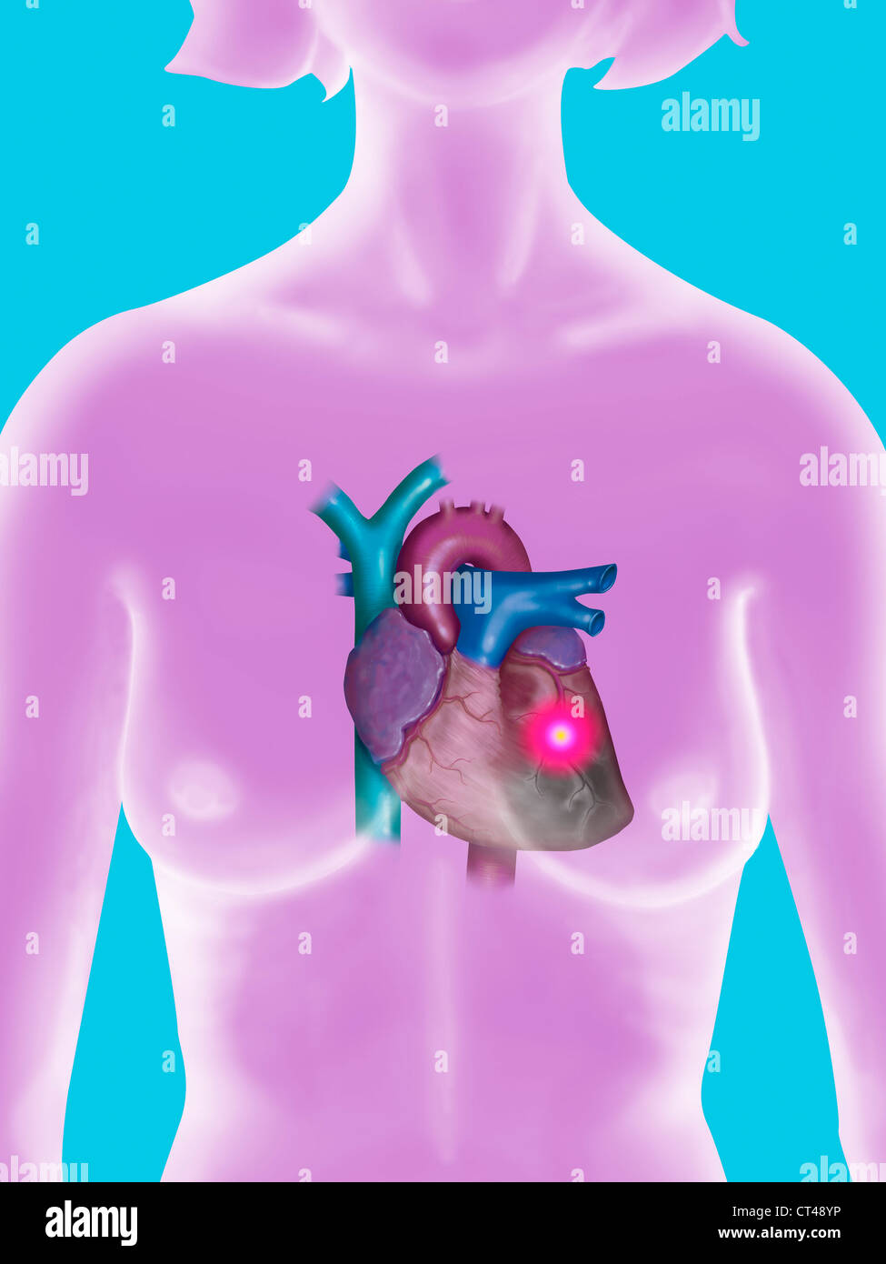 HEART ATTACK, DRAWING Stock Photo - Alamy
