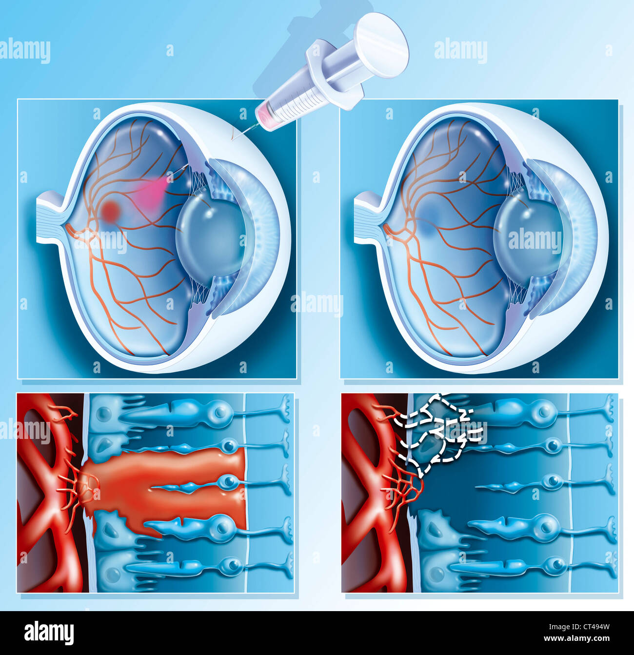 AMD TREATMENT, ILLUSTRATION Stock Photo - Alamy