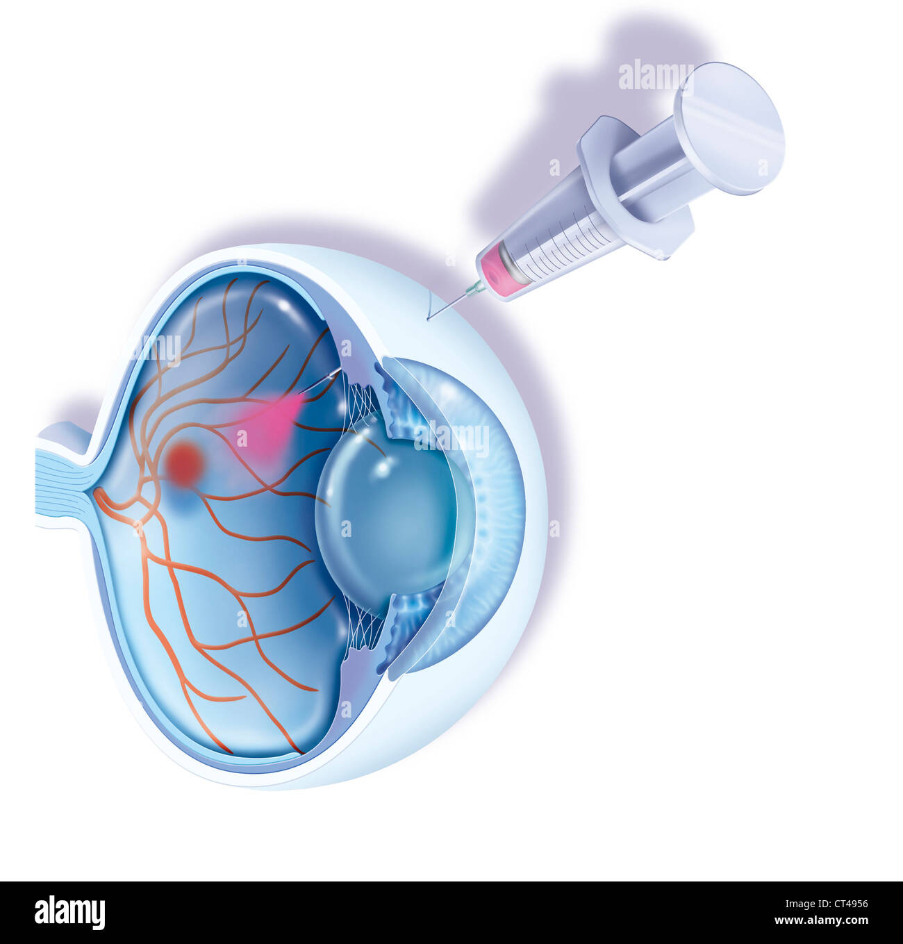 Vision treatment Cut Out Stock Images & Pictures - Alamy