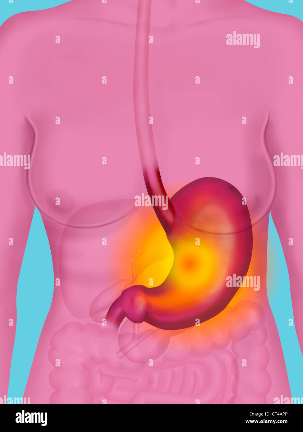GASTRIC ULCER, DRAWING Stock Photo - Alamy