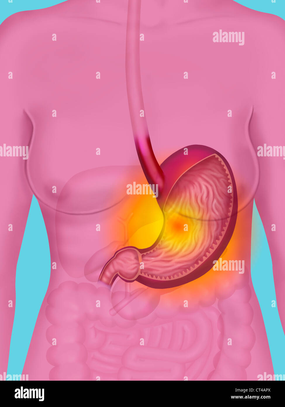 GASTRIC ULCER, DRAWING Stock Photo - Alamy