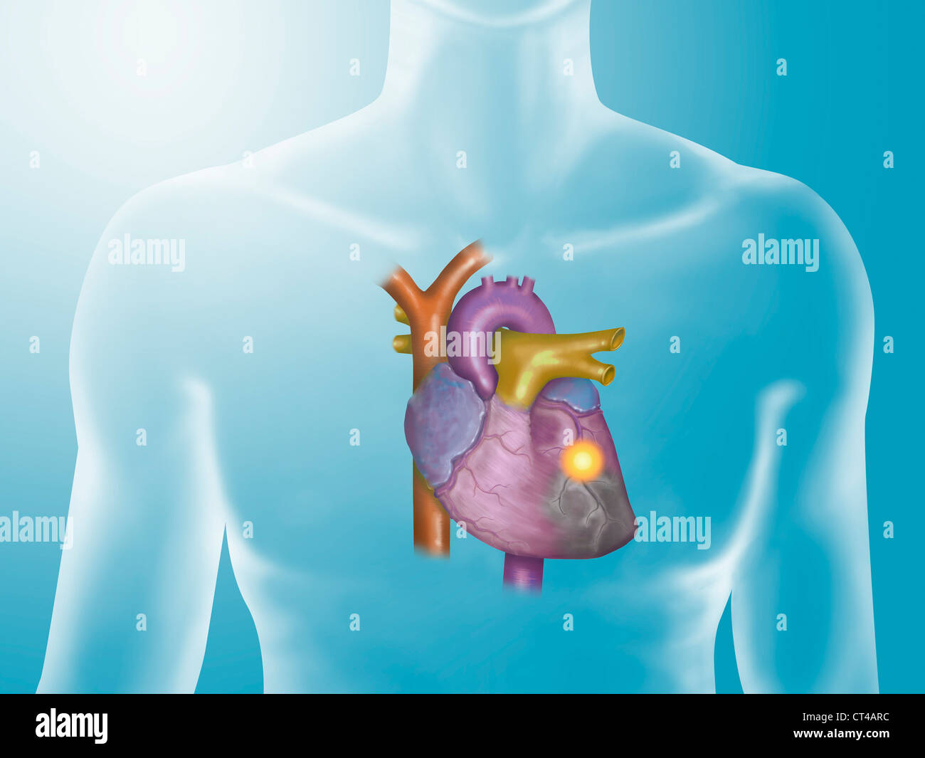 HEART ATTACK, DRAWING Stock Photo - Alamy
