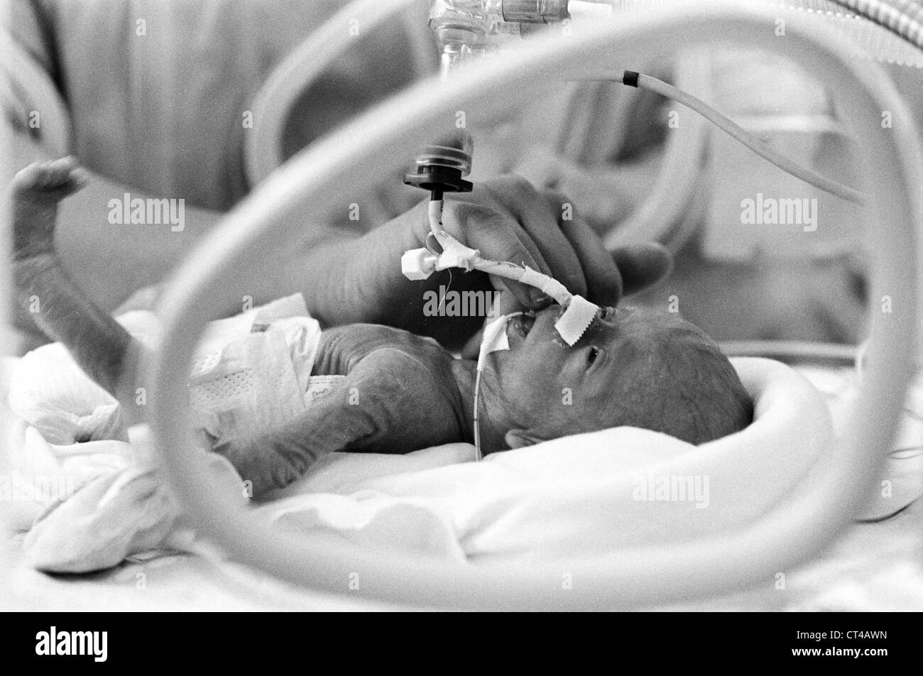 Feeding tube patient Black and White Stock Photos & Images - Alamy
