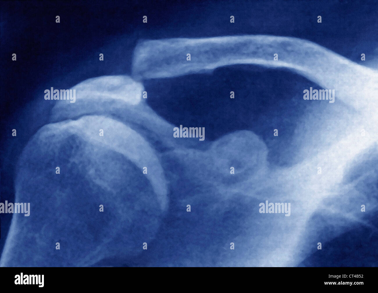 COLLARBONE DISLOCATION, X-RAY Stock Photo - Alamy