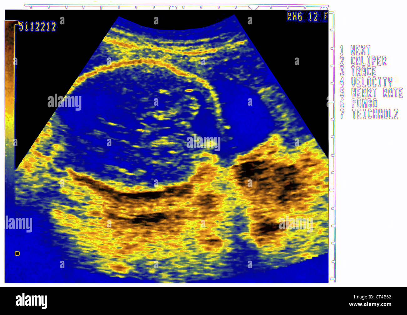 Trisomy 9 hi-res stock photography and images - Alamy