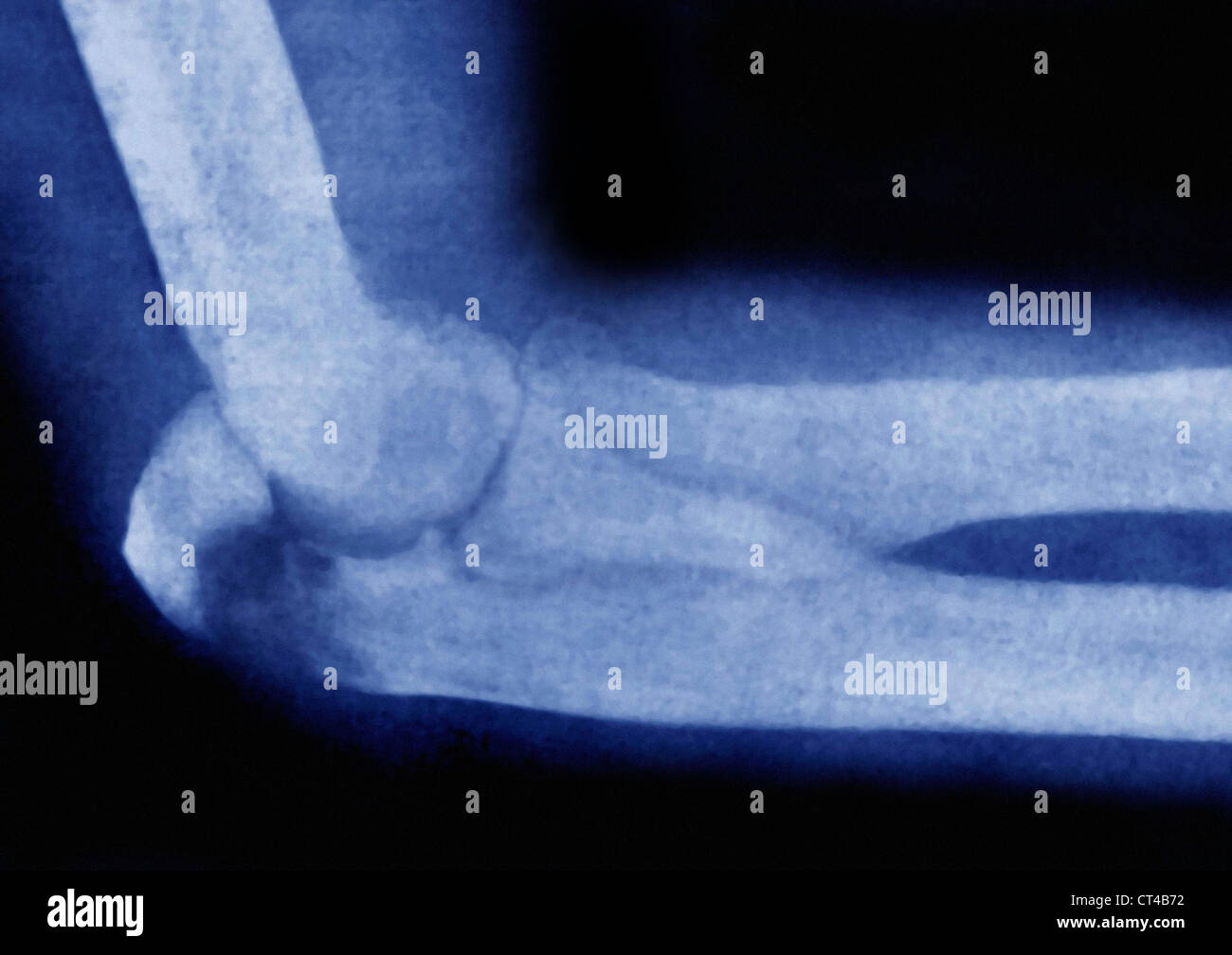 Fractured elbow hi-res stock photography and images - Alamy