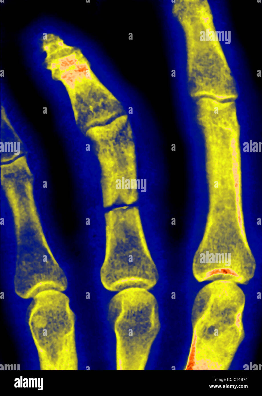 Fractured Hand X Ray High Resolution Stock Photography and Images - Alamy