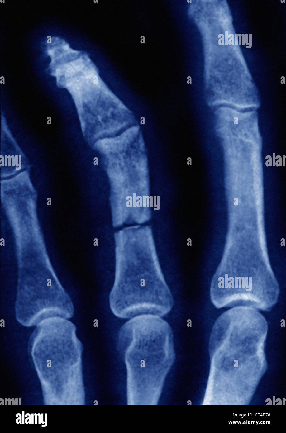 Ring finger injury hi-res stock photography and images - Alamy