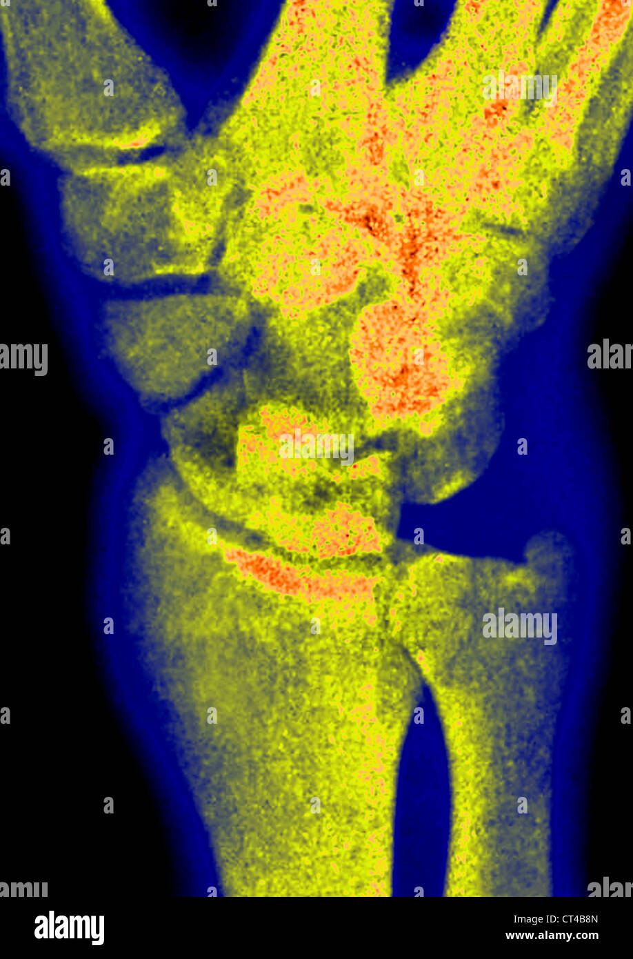 FRACTURED HAND, X-RAY Stock Photo - Alamy